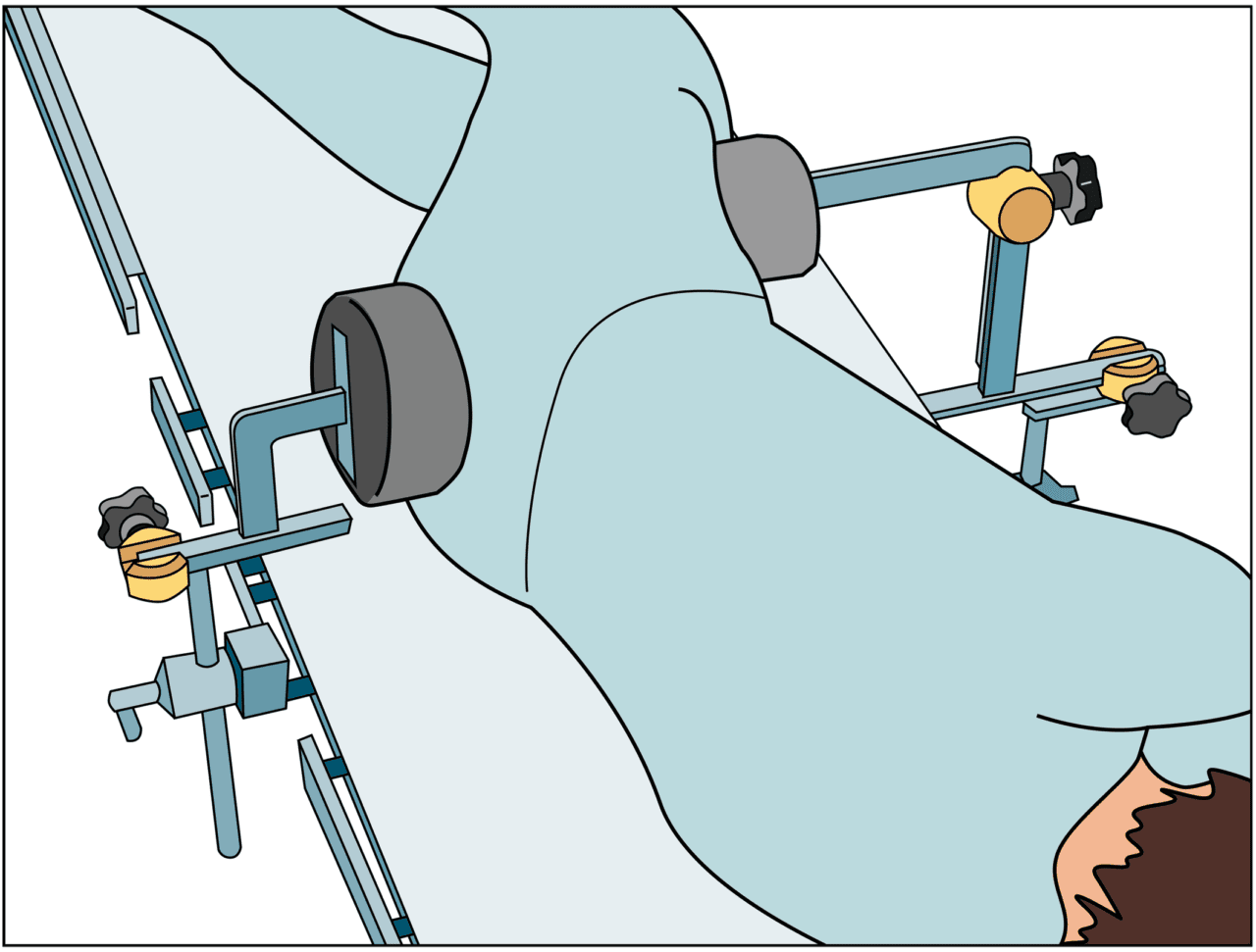 Hip Fix - Opitek International