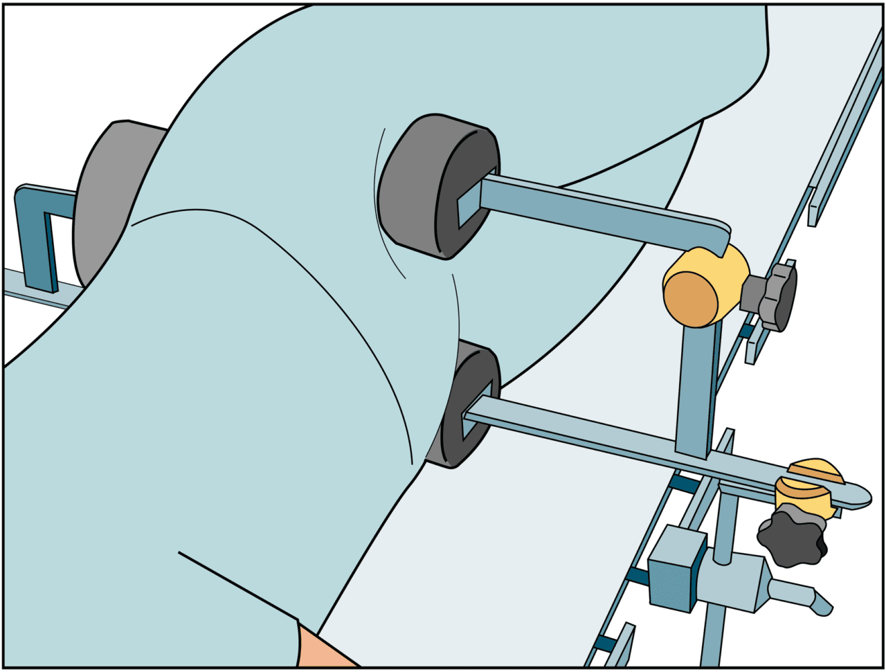 Hip Fix - Opitek International